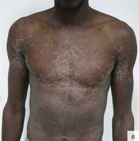 Atypical Cutaneous Manifestations In Syphilis Actas Dermo Sifiliográficas