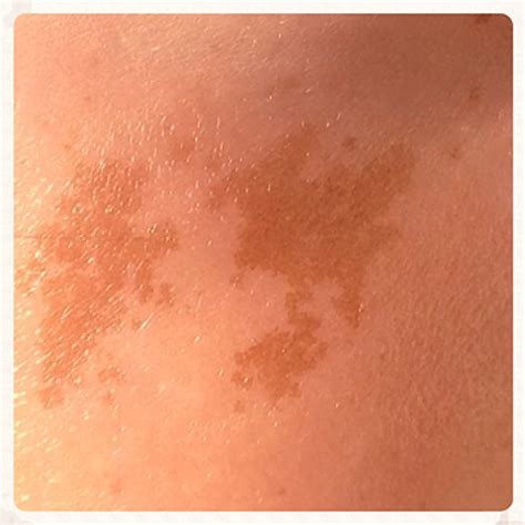 Todo Sobre Las Manchas En La Piel Centro De Estética Elena Somoano