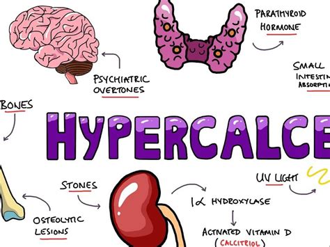 Recommendations Developed For Treating Hypercalcemia Of Malignancy