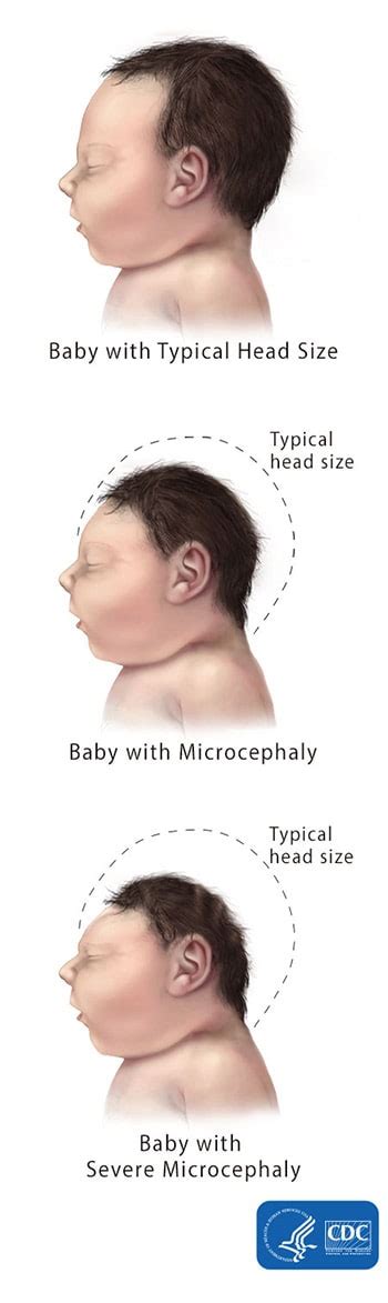 Facts About Microcephaly Birth Defects Ncbddd Cdc