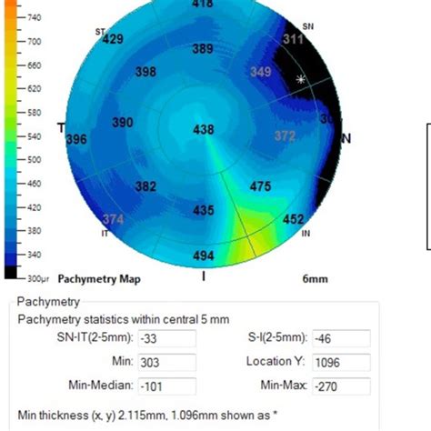 Pachymetry Scan On Anterior Segment Optical Coherence Tomography