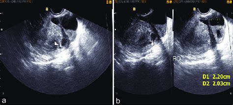 A And B Transvaginal Ultrasound Showing Ectopic Gestational Sac