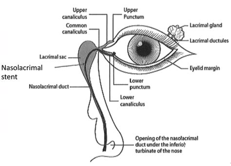 Lacrimal Obstruction — Dr Ye Chen · Oculoplastic Surgeon