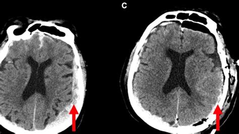 Worlds First Scan Of Dying Brain Reveals Final Moments — Rt World News