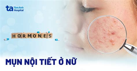 Mụn Nội Tiết ở Nữ Giới Nguyên Nhân Triệu Chứng Và Cách điều Trị