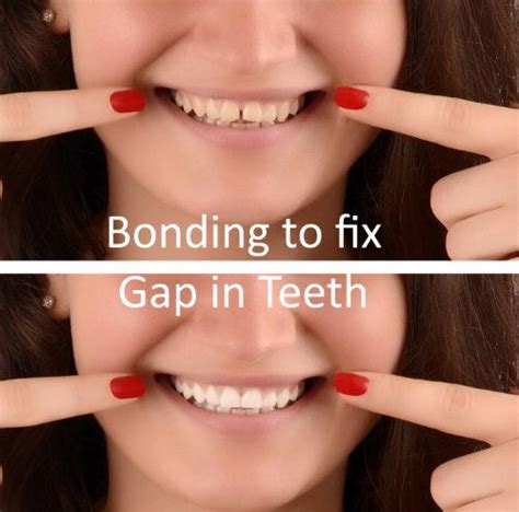 Flower Mound Dental Bonding Flower Mound Tooth Bonding Repair