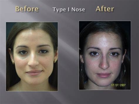 Non Surgical Nose Job In Beverly Hills Ca Dr Sam Assassa