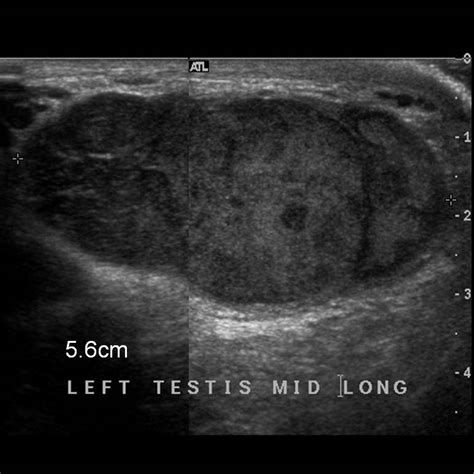 Sonographers Blog Ultrasound Or Ct For Testicular Imaging