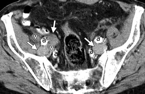 Pathways Of Lymphatic Spread In Male Urogenital Pelvic Malignancies