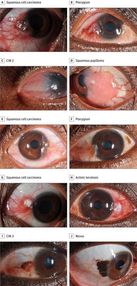 Clinical Presentation Of Ocular Surface Squamous Neoplasia In Kenya