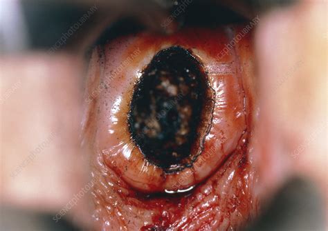 Colposcopic View Of Cervix After Cone Biopsy Stock Image M850 0171