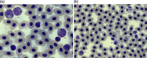 A Three Plasmacytes [large Plasmacytoid Lymphocytes Lpl ∼7 5μm] A