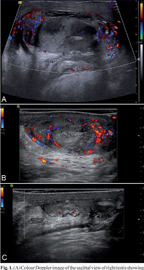 Figure 1 From Testicular Infarction In A Patient With Spinal Cord