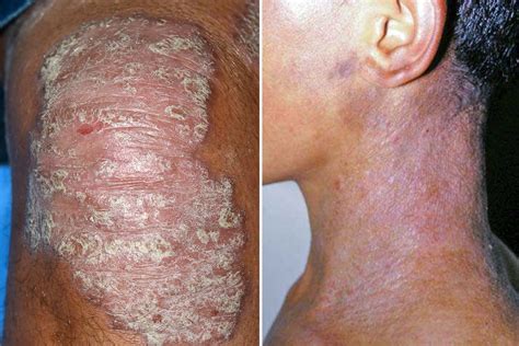 Psoriasis Vs Eczema Understanding The Differences 55 Off