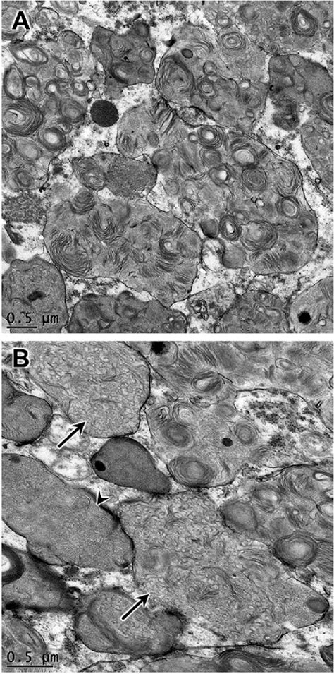 Electron Micrographs Of Disease Related Inclusion Bodies In The