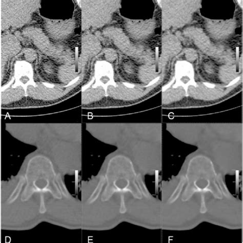 Effect Of Ct Reconstruction By Fbp A D And Asir Levels Of 50 B E
