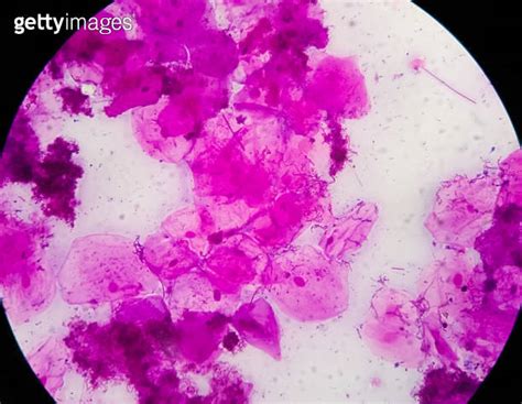 High Vaginal Swab Hvs Gram Stain Microscopic 100x Show Few Pus Cells