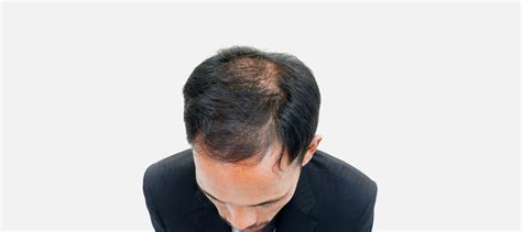 Hair Loss Clear Dermatology