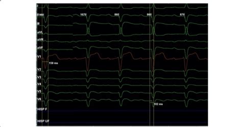 Baseline Ecg With Intraventricular Conduction Delay Ivcd With Wide