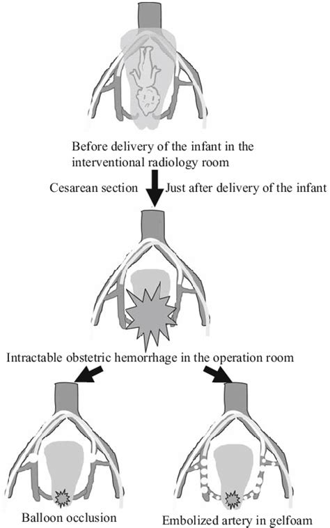 Uterine Artery Embolization For Postpartum Hemorrhage