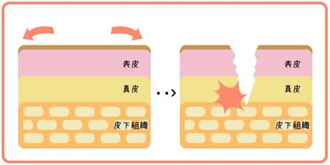 妊娠線はなぜできる？できる原因を知りたい！ 〜妊娠線5分講座〜予防から産後ケアまで全部おまかせ！