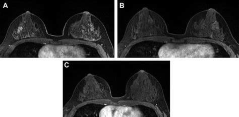 Background Parenchymal Enhancement Radiologic Clinics