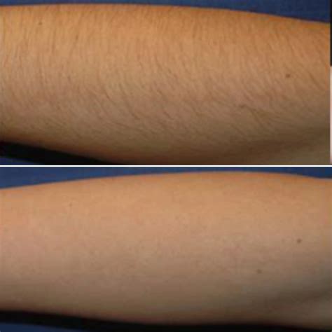 Laser Hair Removal Arms Before After Online