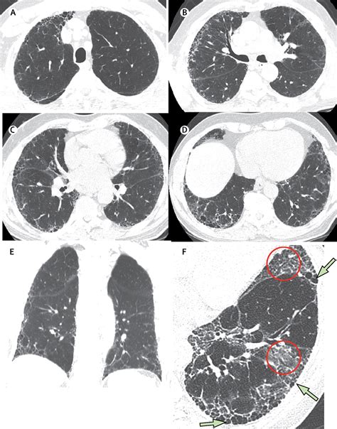 Diagnostic Criteria For Idiopathic Pulmonary Fibrosis A Fleischner