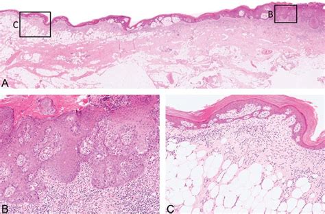 Invasive Extramammary Paget Disease Showing Intradermal Band Like