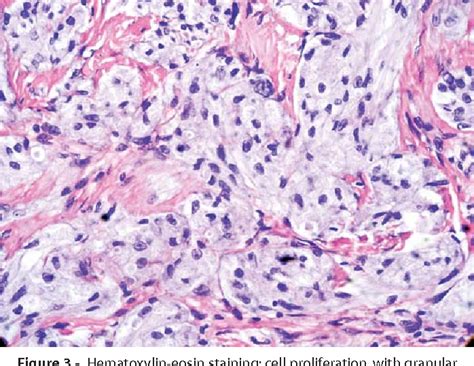 Figure 2 From Vulvar Granular Cell Tumor Abrikossoff S Tumor
