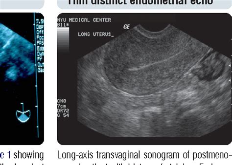Uterus Ultrasound Transvaginal