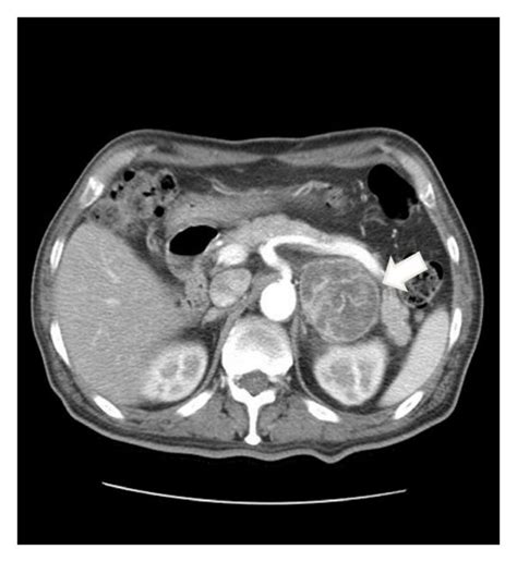 Contrast Enhanced Abdominal Computed Tomography Shows A Heterogeneously