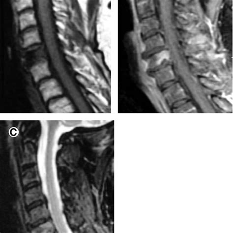 Osteoporotic Compression Fracture Of T12 L2 And L3 Vertebrae In A