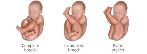 Complete Breech Position Atelier Yuwa Ciao Jp