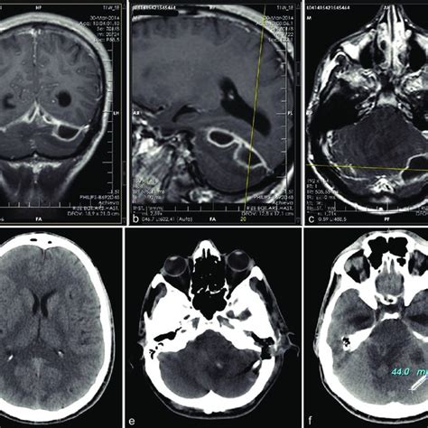 Preoperative Magnetic Resonance Imaging And Early Postoperative