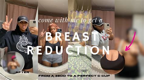 “boob Job” 20 Aka A Breast Reduction Post Op Drainage Removal