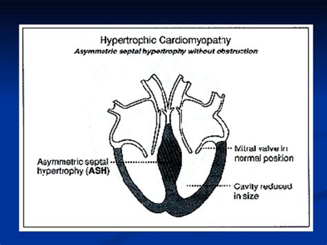 Hypertrophic Obstructive Cardiomyopathy Hocm