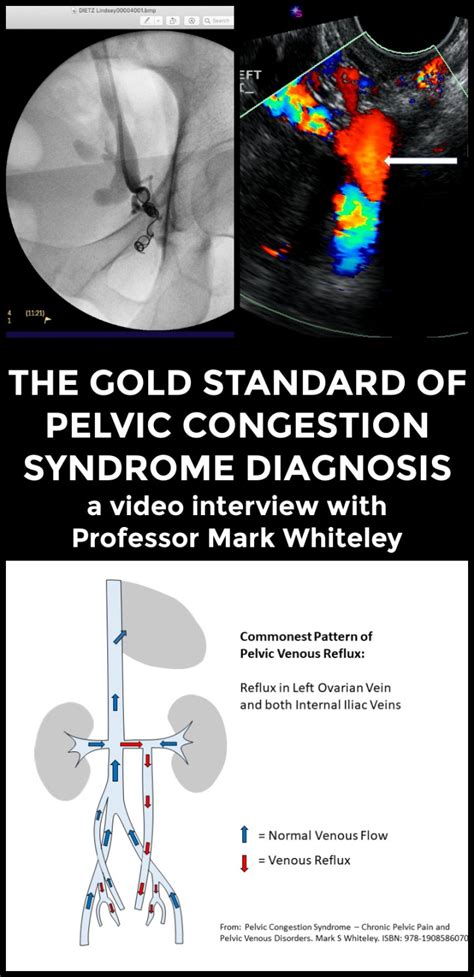 The Gold Standard Of Pelvic Congestion Syndrome Diagnosis With
