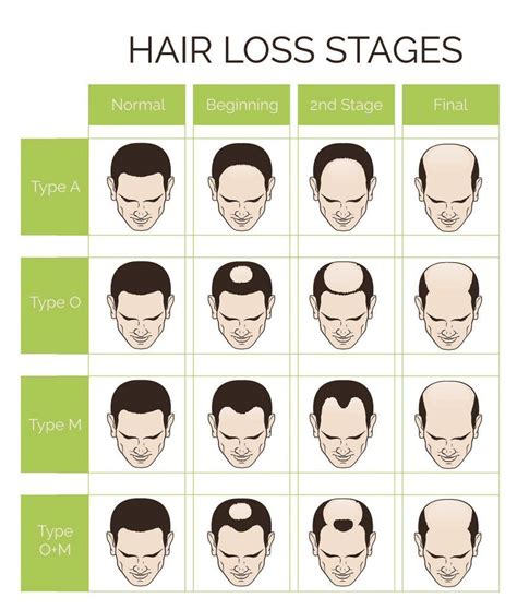 How To Stop Receding Hairline A Comprehensive Guide Ihsanpedia
