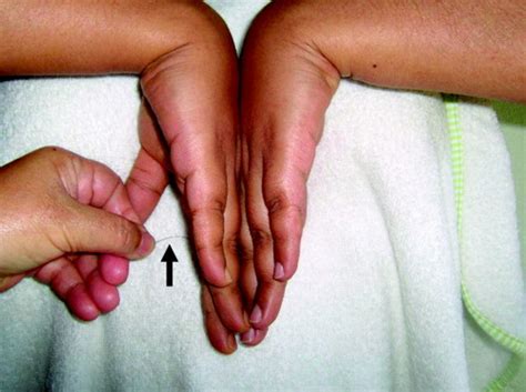 Modified Phalens Test As An Aid In Diagnosing Carpal Tunnel Syndrome