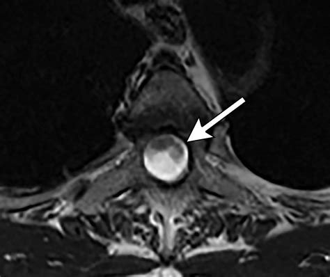 Diagnostic Approach To Intrinsic Abnormality Of Spinal Cord Signal