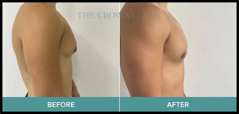 Gynecomastia Surgery Results Crown Clinic
