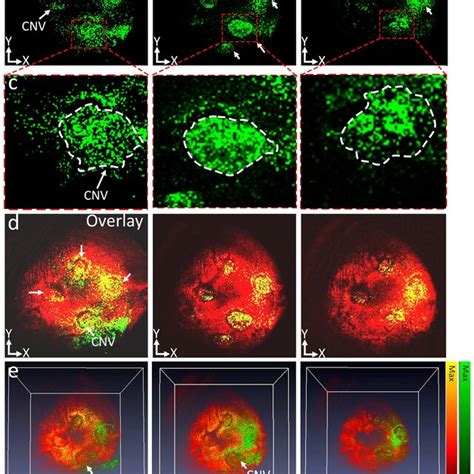 In Vivo Pam Visualization Of Cnv Lesions A B 2d Pam Images Achieved