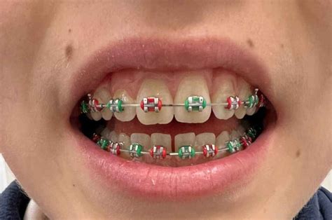 Coloured Elastics Braces Cost Of Treatment Kingston Orthodontics