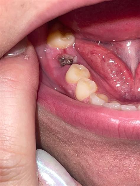 Dry Socket Vs Normal Socket Causes Symptoms And Treatments