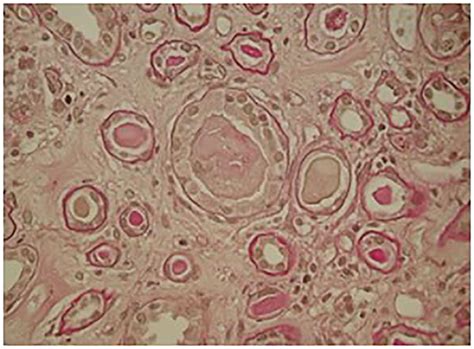 frontiers case report a case of igd lambda lambda multiple myeloma