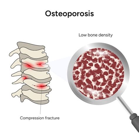 Premium Vector Osteoporosis Low Bone Density Infographic In Vector