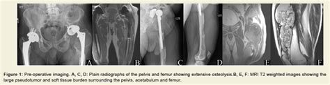 Avens Publishing Group Pseudotumor Treated With Two Stage Revision
