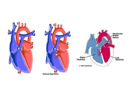 Ppt Ventricular Septal Defect Vsd Powerpoint Presentation Id 6330625