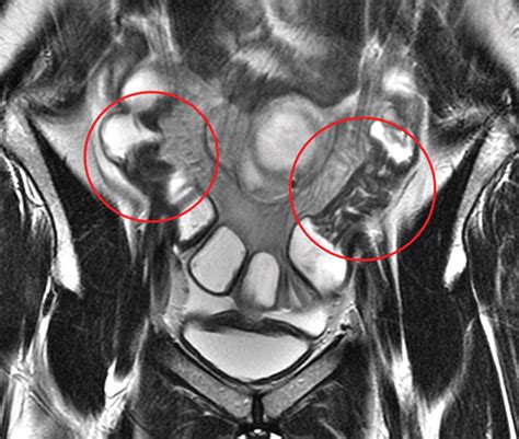 Findings Of Pelvic Endometriosis At Transvaginal Us Mr Imaging And